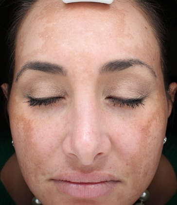 Different Types of Hyperpigmentation - The Skin Center by CPS