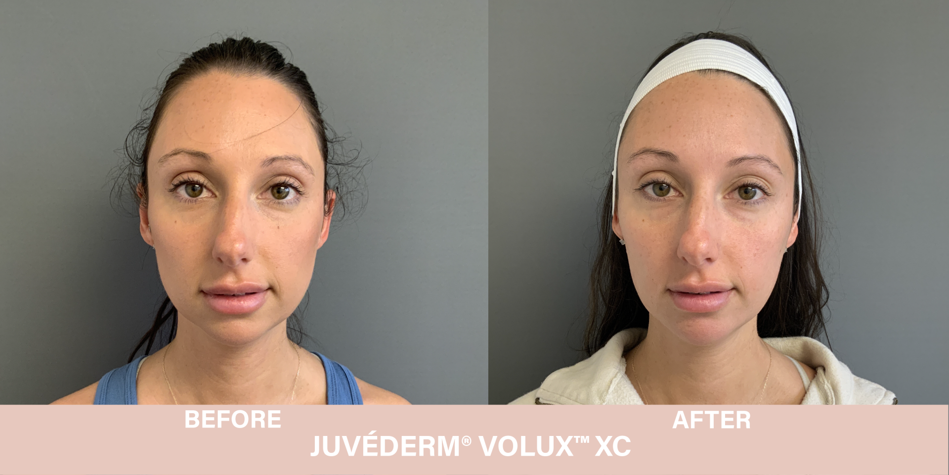 Juvederm Volux | Cosmetic Injectables