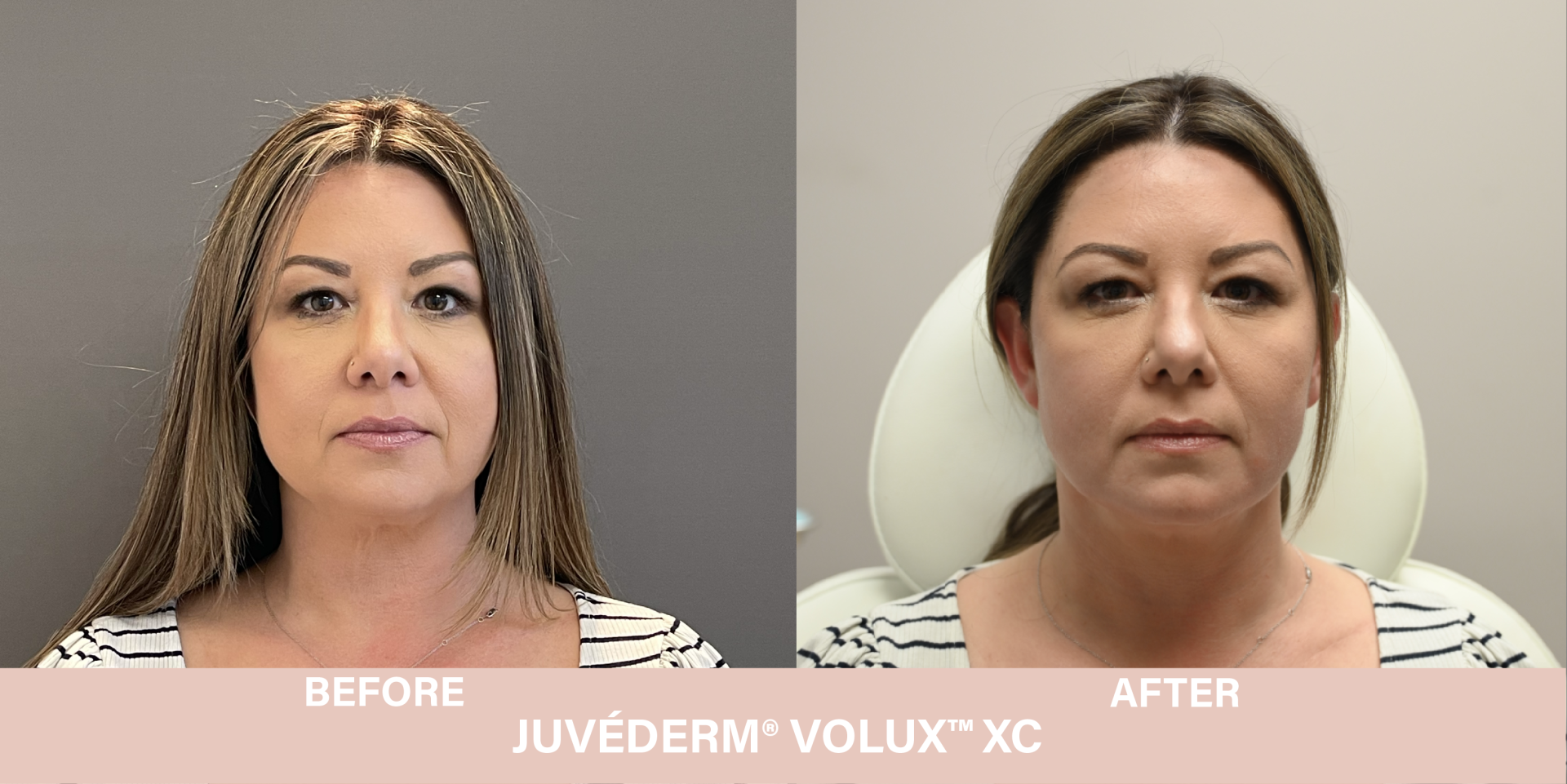Juvederm Volux | Cosmetic Injectables