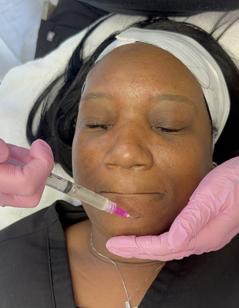 What is PRX Derm Perfexion? | The Skin Center by CPS